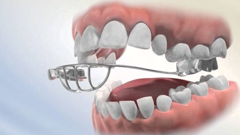 What Is a Tongue Crib? - 25pr